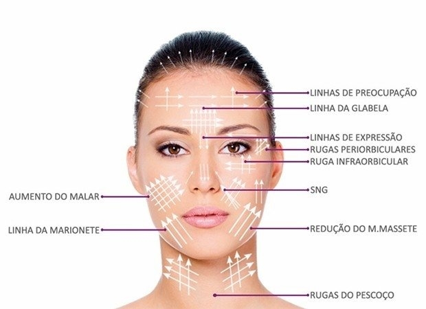 FIOS FILLER 21G x 38mm x 50mm / I-THREAD- 20 fios no pacote.